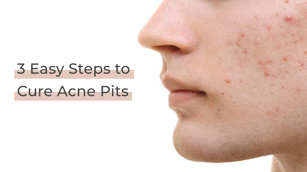 3 Easy Steps to Cure Acne Pits | Acne Pits Treatment | Acne Pits ...