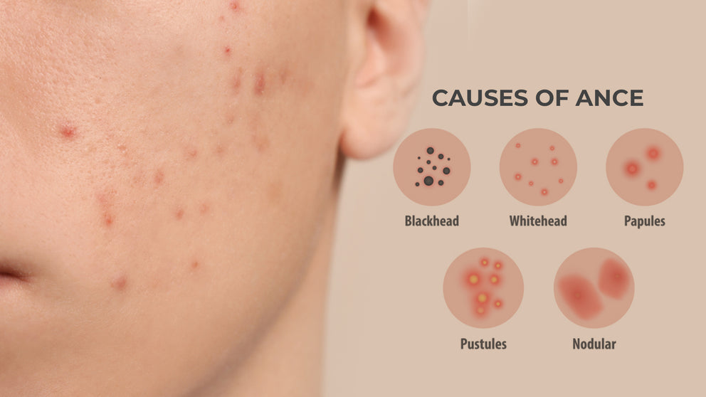 5 Types Of Acne You Should Know About | Causes of Acne | Acne Fighter ...