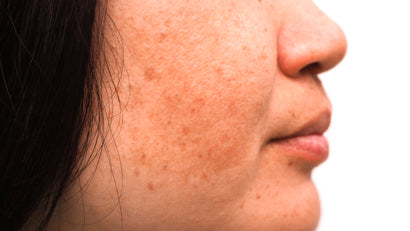 Here is everything you need to know about Melasma, Causes, and ...