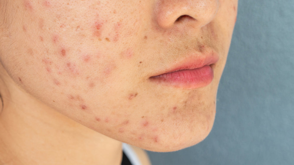 How To Deal With Period Acne | Reduces Acne Dark Spots | Serum For Acne ...