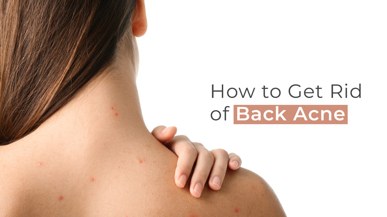 How to Get Rid of Back Acne? - Suganda Skincare