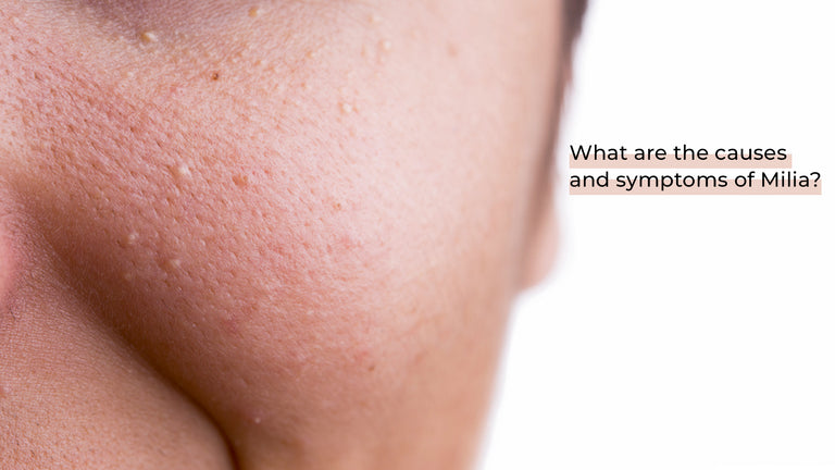 What are the Milia? | Acne causes, symptoms, and treatment | Acne ...