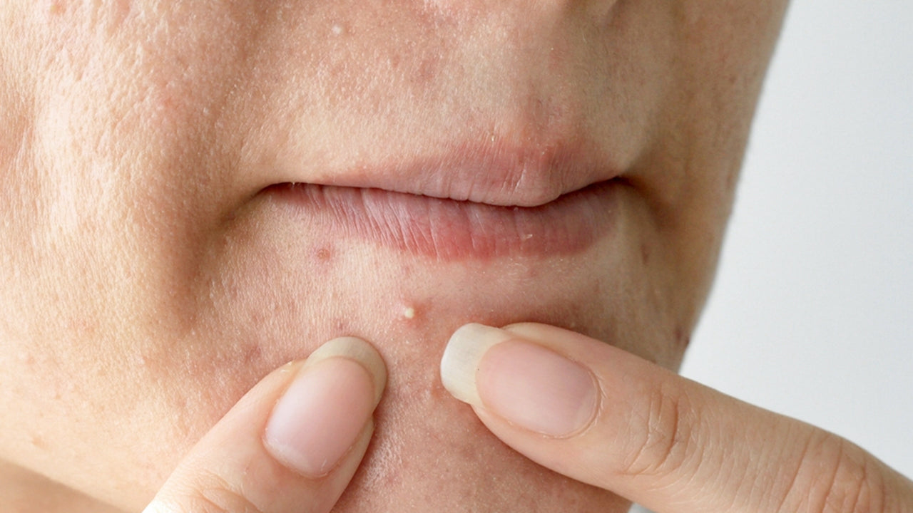 Six effective Steps to Deal with Acne |Skincare Routine for Acne-Prone ...