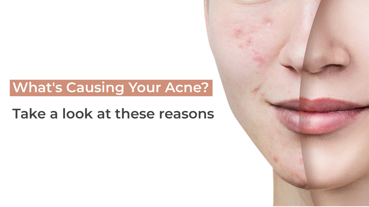What's Causing Your Acne? Take a Look At These Reasons – Suganda Skincare